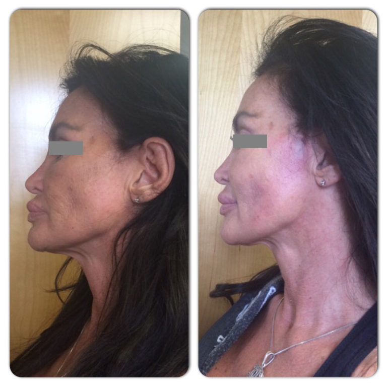 Bellafill for Volume Loss around Temples - Butterfly Antiaging Clinic